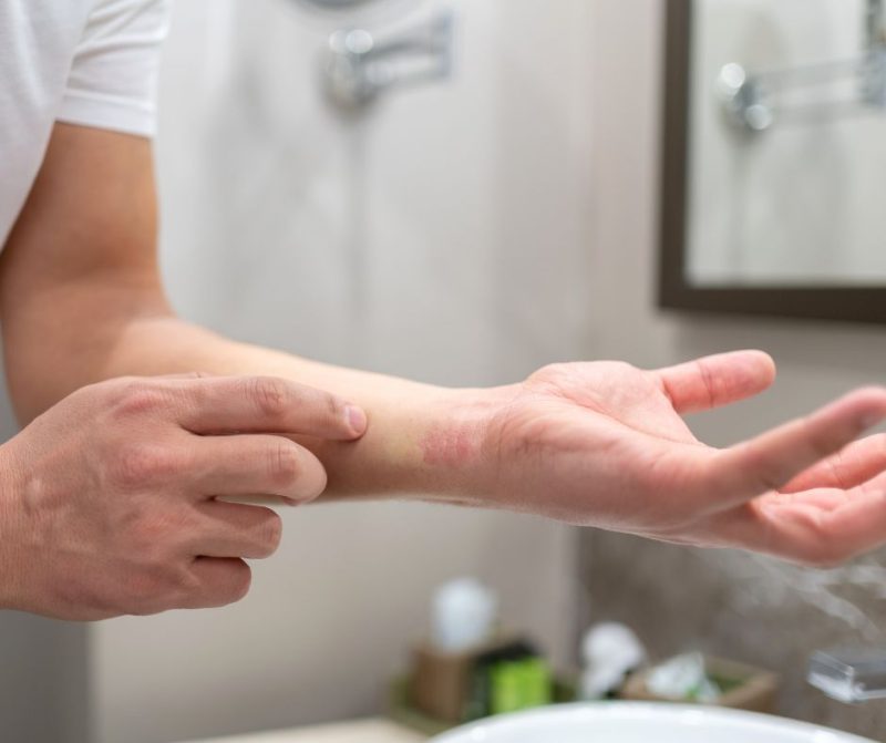 Top 5 Rarest Allergies in the World - America's Best Care Plus